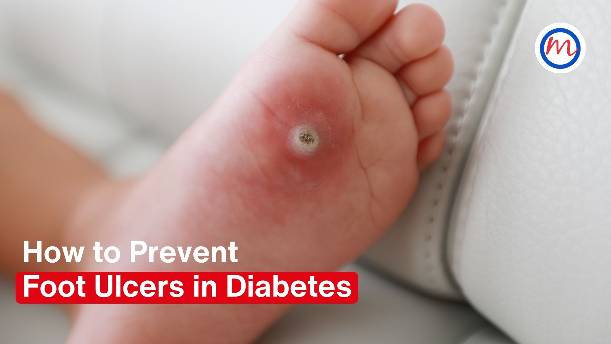 How to Prevent Foot Ulcers in Diabetes